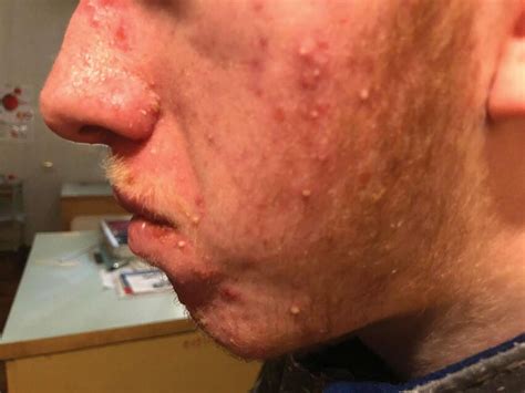 Facial Appearance Multiple Papular And Pustular Acne In Rosacea Download Scientific Diagram
