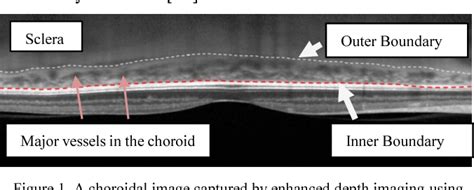 figure 1 from automated segmentation of the choroid in retinal optical