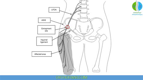 Lateral Femoral Cutaneous Nerve Anatomy Orthofixar