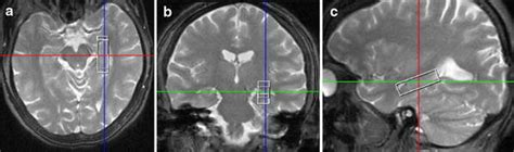 Magnetic Resonance Imaging Mri Demonstrating The Localization And Download Scientific Diagram