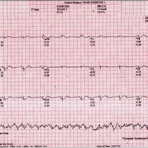 Electrocardiogram At Stage 3 Of Exercise Treadmill Test 57 Download Scientific Diagram