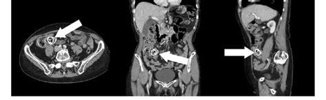 Axial Coronal And Sagittal Ct Views Showing A Giant Appendicolith