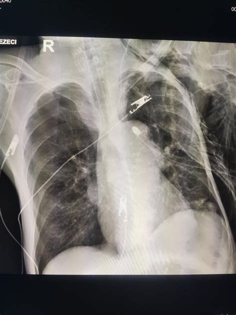 Cvc Successfully Placed Rradiology