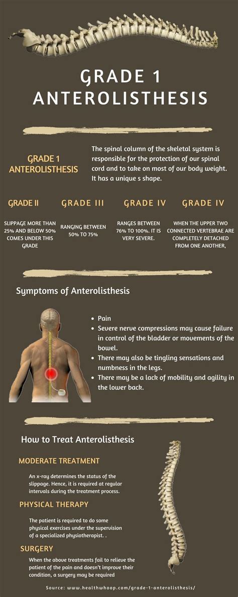 Pin On Grade 1 Anterolisthesis
