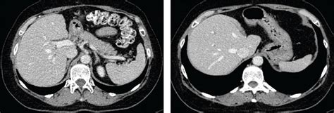 Впечатляющий ответ на двойное ингибирование Braf и Mek у пациентки с