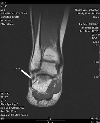 Uw Msk Resident Projects Ligaments Of The Ankle
