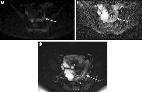 Inflammatory Diffusion Restriction Axial Diffusion Weighted B 900