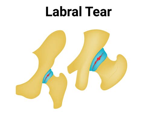 Labral Tear Science Design Vector Illustration Diagram 40983137 Vector Art At Vecteezy Labral Tear Science Design Vector Illustration Diagram 40983137 Vector Art At Vecteezy