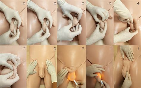 Essential Skills Of Scrotal Examination A Step‐by‐step Technique