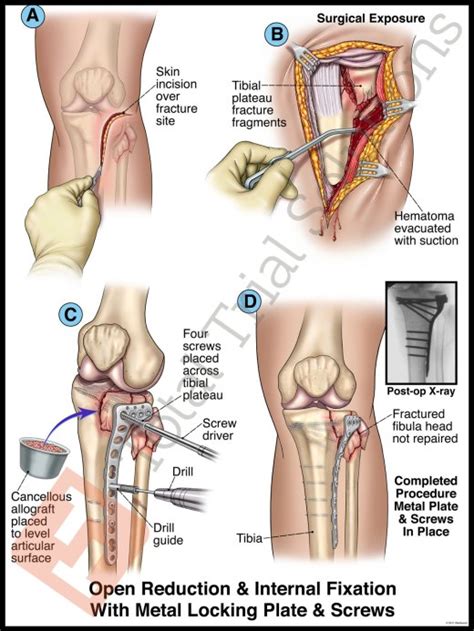 Medical Illustration Open Reduction And Internal Fixation Of Left Tibial Plateau And Fibula