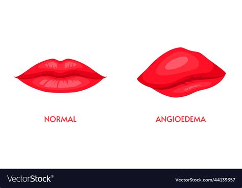 Angioedema Or Edema Of Lips Allergic Swelling Vector Image