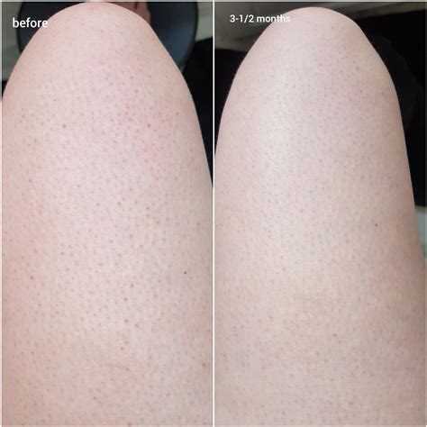 First Aid Beauty Kp Bump Eraser Body Scrub Review Raiyne On Beauty