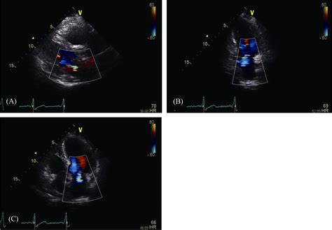 The Follow Up Echocardiography After A Month Showing Mild Mitral
