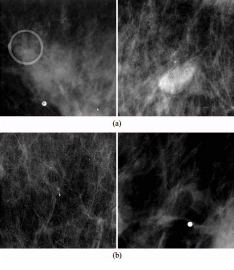 Figure 5 From Analysis Of Perceived Similarity Between Pairs Of Microcalcification Clusters In