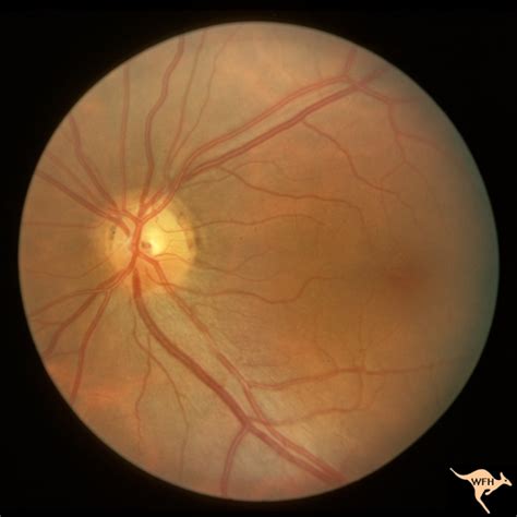 Segmental Atrophy Altitudinal Eccles Health Sciences Library J Willard Marriott Digital