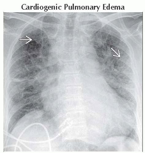 Interlobular Septal Thickening Thoracic Key