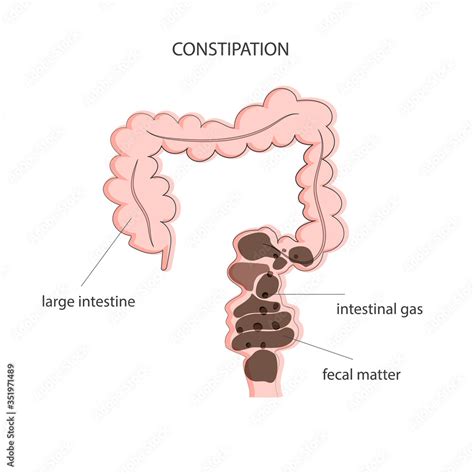 Fecal Obstruction And Gas Accumulation In The Colon Medical Poster