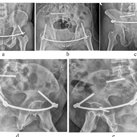Postoperative Images Of Case 1 A Pelvic Anteroposterior X Ray Image Download Scientific