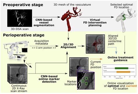 Computer Aided Intracranial Aneurysm Treatment Based On 2d3d Mapping Virtual Deployment And