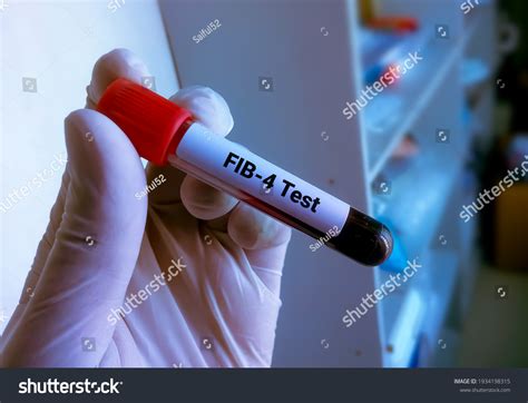 Blood Sample Fib Fibrosis Test Diagnosis Stock Photo Edit Now