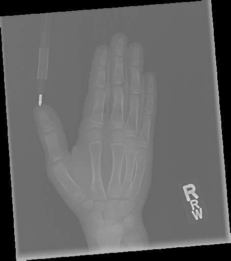 Unsupervised Anomaly Detection For X Ray Images Deepai