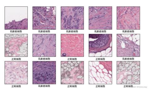 卷积神经网络（cnn）：乳腺癌识别ipynb