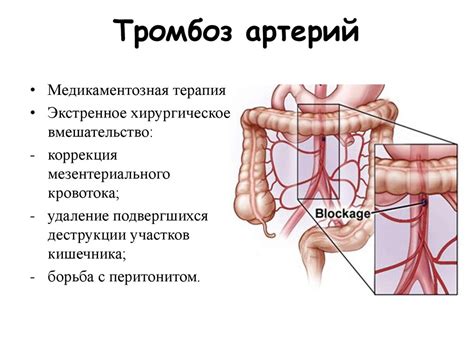 Хирургическое лечение тромбоза мезентеральных сосудов - online presentation