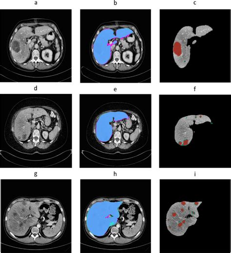 Deep Learning Models For Automatic Tumor Segmentation And Total Tumor Volume Assessment In
