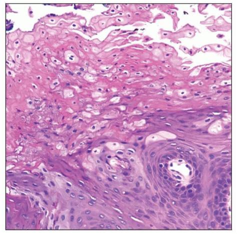 Hairy Leukoplakia Basicmedical Key