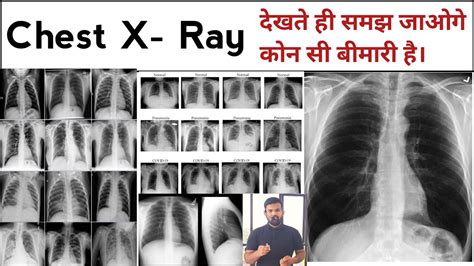 Chest X Ray X Ray X Ray Reading Pneumonia Lungs Effusion X