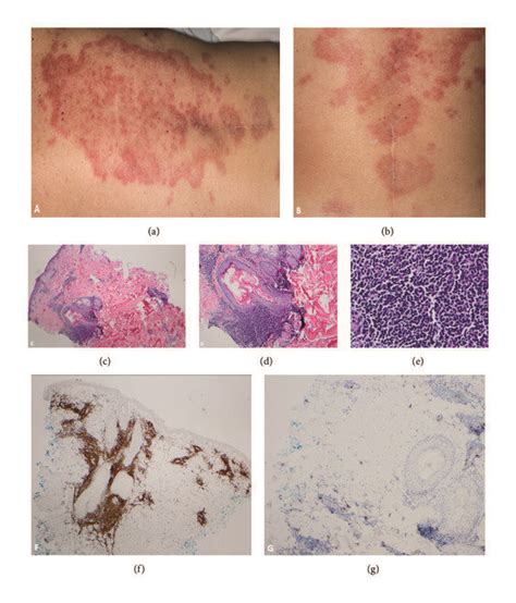 Annular Erythematous Maculopapular Lesions On The Upper And Lower Back Download Scientific