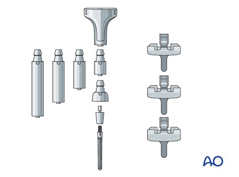 Proximal Tibia Replacement For Fracture Around A Loose Tibial Component With Poor Bone Stock