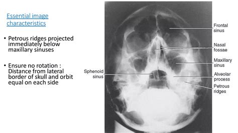 X Ray Pnspptx