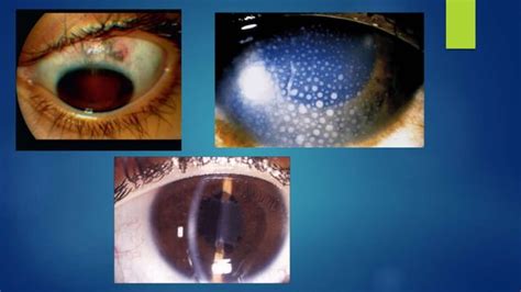 Sympathetic Ophthalmia And Vkh Syndrome Pptx Eye And Vision