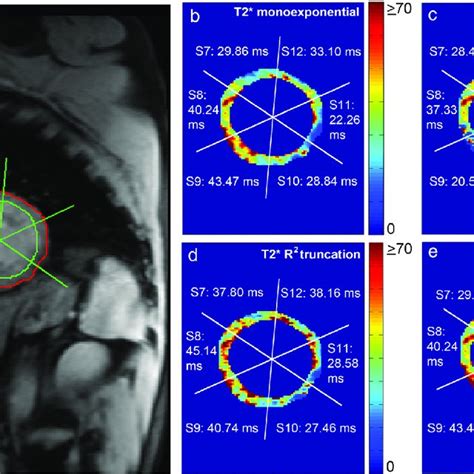 Bulls Eye Plots Showing Global Myocardium Using Aha 16 Segments Model Download Scientific