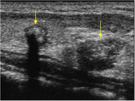 Head And Neck 4 1 Thyroid Gland Case 4 1 3 Thyroid Malignant Lesions Ultrasound Cases