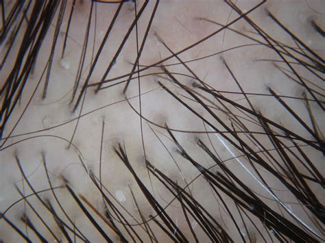 Patterned Hair Loss British Hair And Nail Society