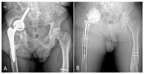 Prosthesis Free Full Text A Combined Use Of Custom Made Partial Pelvic Replacement And