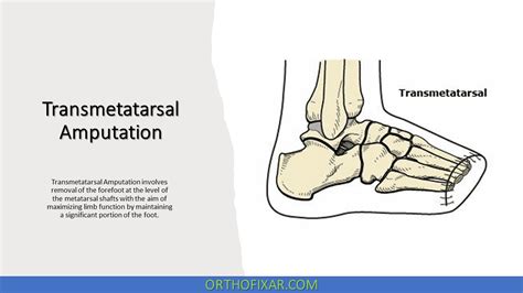 Tarsometatarsal Amputation Upper Limb Considerations Physiopedia