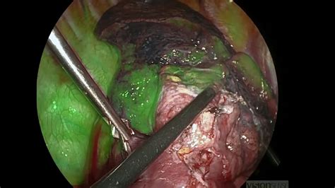 Thoracoscopic Non Anatomical Lung Segmentectomy For Intralobar