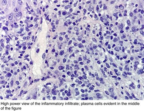 Pathology Outlines Syphilis