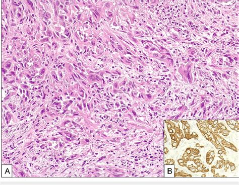 sarcomatoid carcinoma stained with hematoxylin and eosin the tumor is