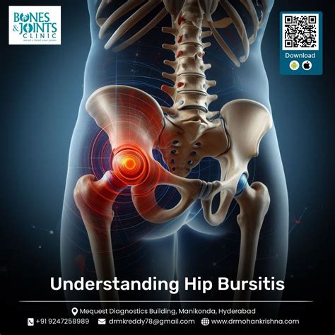 Beware Of Hip Bursitis At Bones And Joints Dramohan Krishna Posted