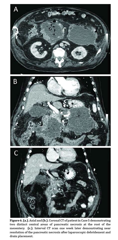 Pancreatic Necrosis Recovery