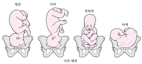 신생아의 출산 손상 아동의 건강 문제 Msd 매뉴얼 일반인용