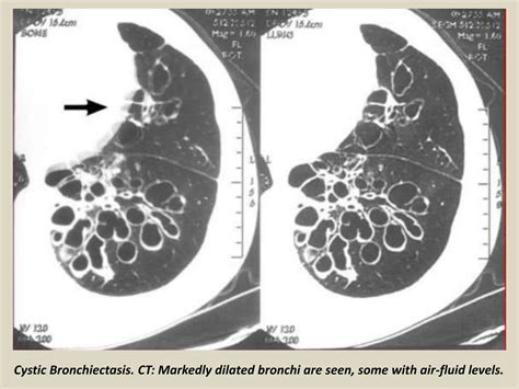 Presentation1pptx Radiological Imaging Of Bronchiectasis Pptx