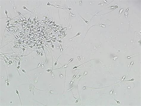 Sperm Agglutination In A Buergers Disease Bd Patient With Negative