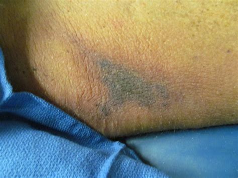 Atypical Wounds Calciphylaxis Accessmedicine Network