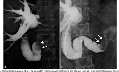 Figure 1 From Percutaneous Cholangioscopic Lithotripsy For Afferent Loop Syndrome Caused By
