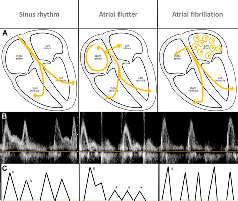 Antithrombotic Therapy In Atrial Flutter To Anticoagulate Or Not That